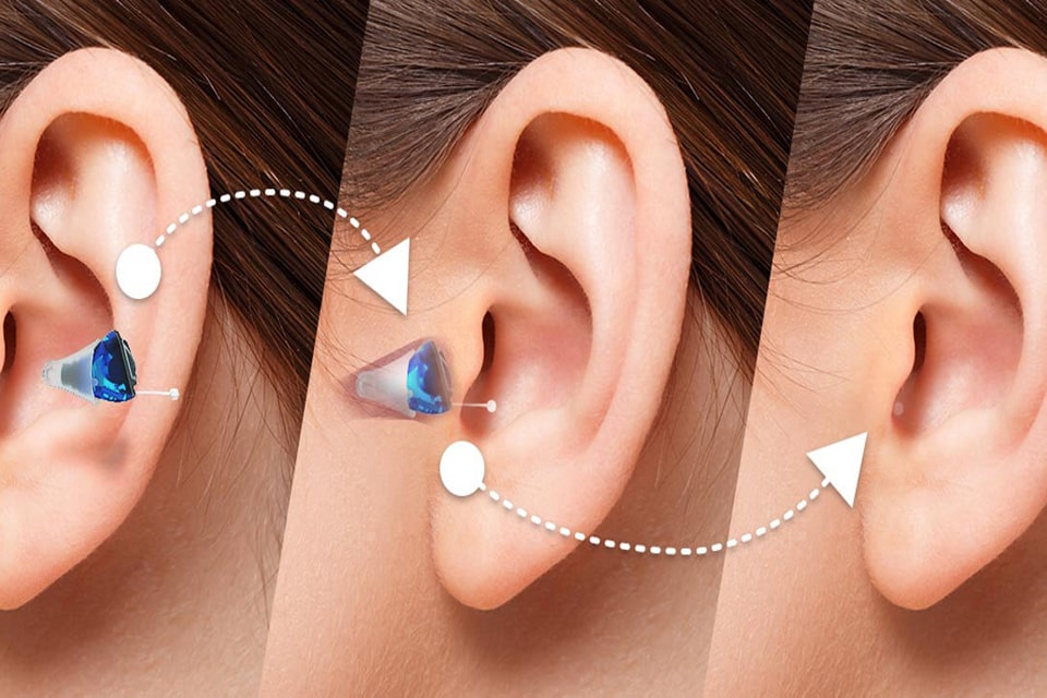 Signia Silk Nx Hearing Aid Latest Hearing Aid Technology